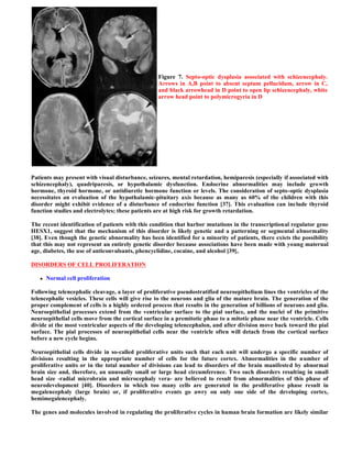 Case record...Cortical dysplasia | PDF