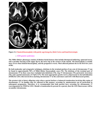 Case record...Cortical dysplasia | PDF