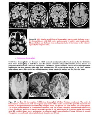 Case record...Cortical dysplasia | PDF