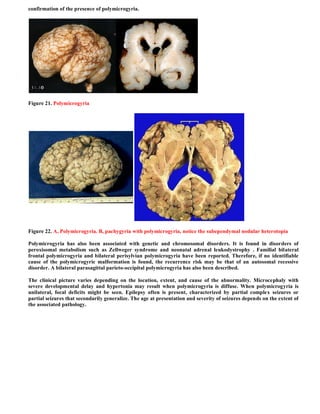 Case record...Cortical dysplasia | PDF