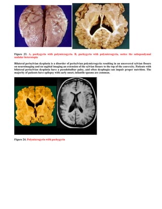 Case record...Cortical dysplasia | PDF