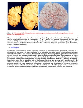 Case record...Cortical dysplasia | PDF