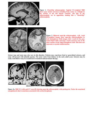Case record...Cortical dysplasia | PDF