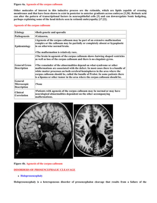 Case record...Cortical dysplasia | PDF