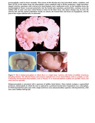 Case record...Cortical dysplasia | PDF