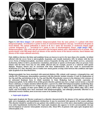 Case record...Cortical dysplasia | PDF