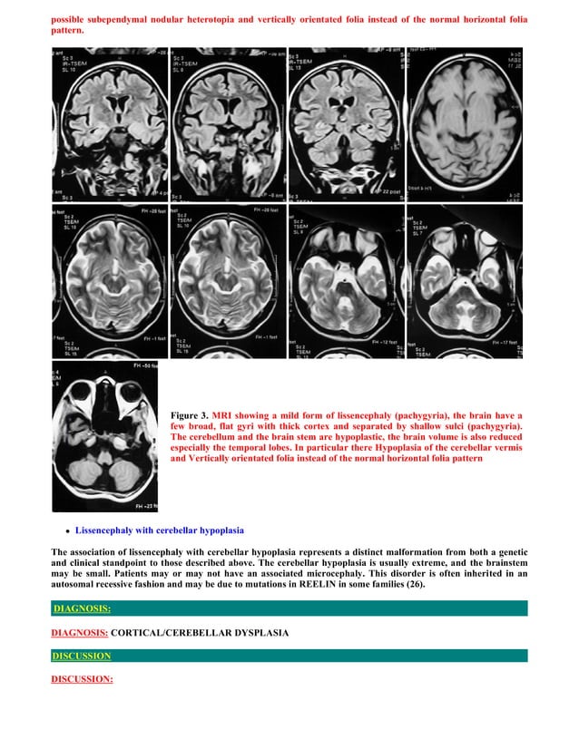 Case record...Cortical/cerebellar dysplasia | PDF | Brain and Nervous ...