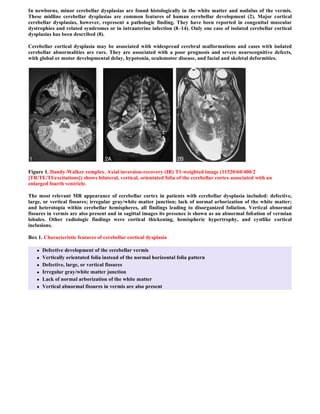 Case record...Cortical/cerebellar dysplasia | PDF