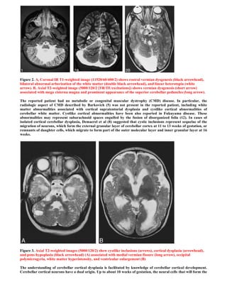 Case record...Cortical/cerebellar dysplasia | PDF | Brain and Nervous ...