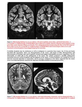 Case record...Cortical/cerebellar dysplasia | PDF | Brain and Nervous ...