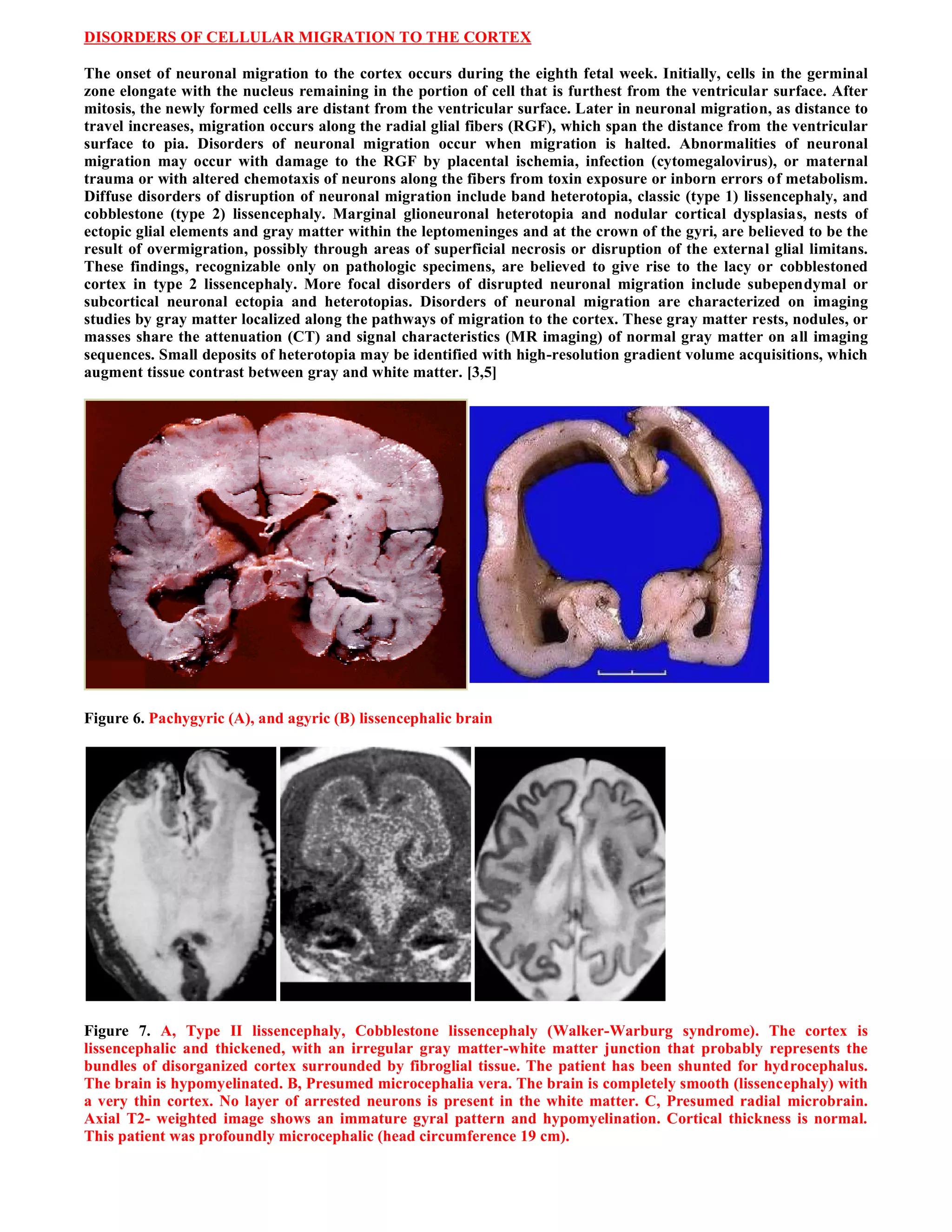 Case record...Cortical dysplasia | PDF