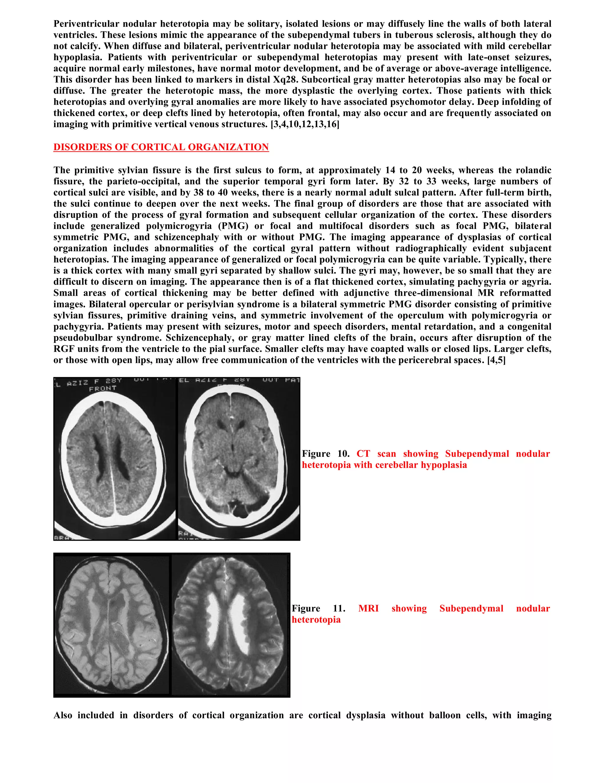Case record...Cortical dysplasia | PDF