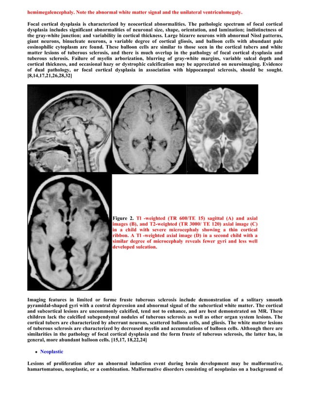 Case record...Cortical dysplasia | PDF | Brain and Nervous System ...
