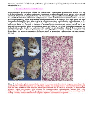 Case record...Cortical dysplasia | PDF | Brain and Nervous System Disorders | Diseases and ...