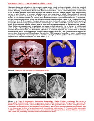 Case record...Cortical dysplasia | PDF | Brain and Nervous System ...