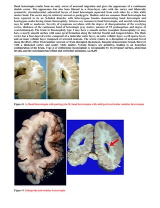 Case record...Cortical dysplasia | PDF | Brain and Nervous System ...