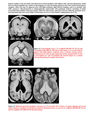 Case record...Cortical dysplasia | PDF | Brain and Nervous System ...