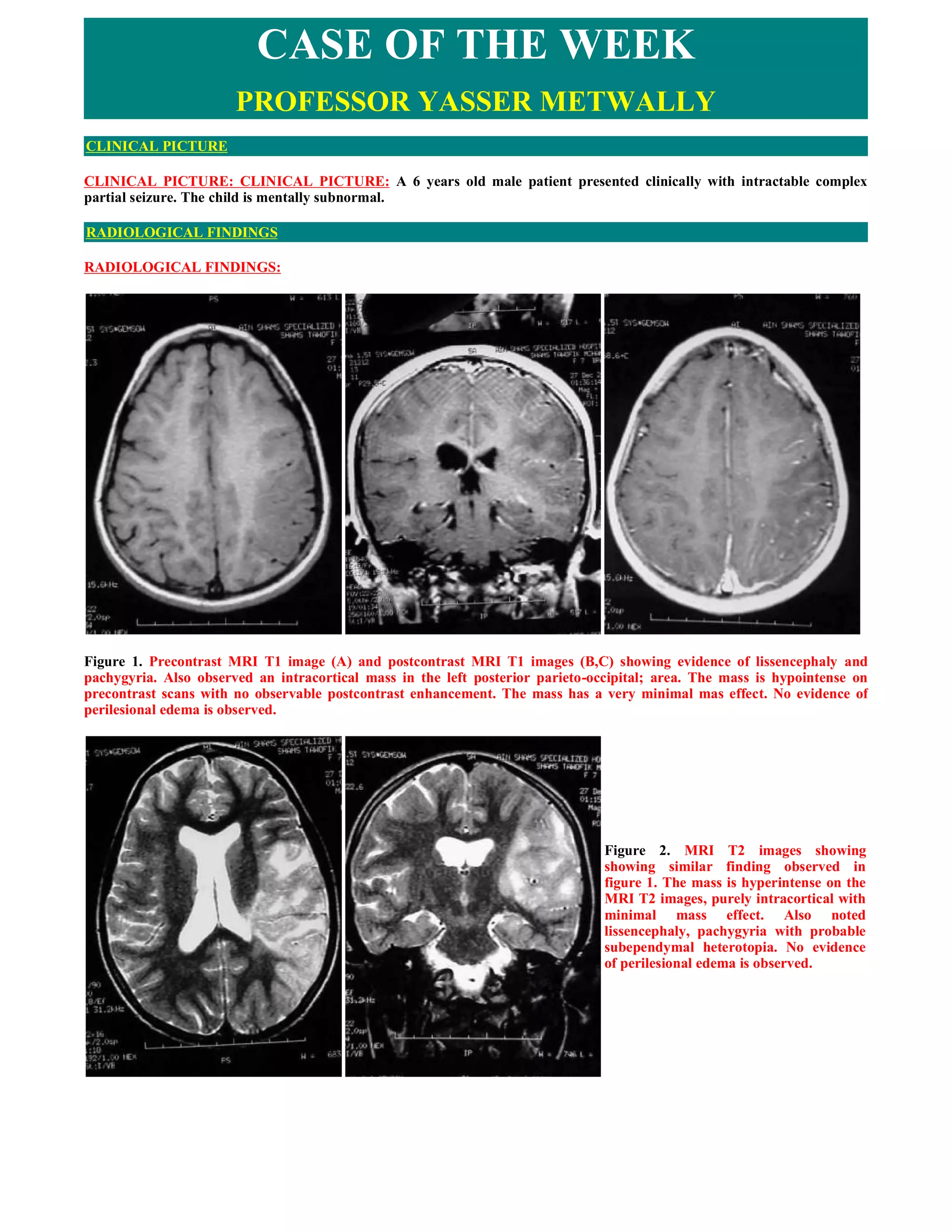 Case record...Dysembryoplastic neuroepithelial tumor | PDF