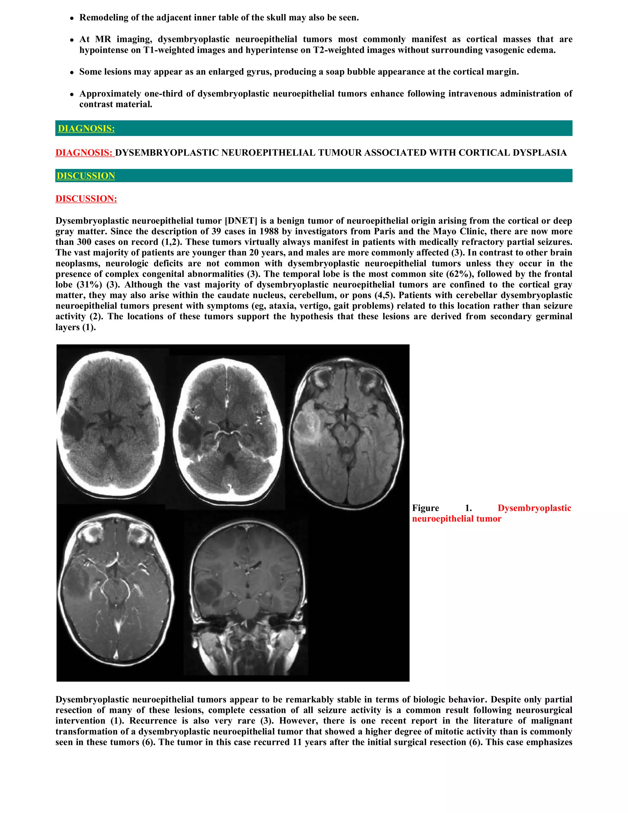 Case record...Dysembryoplastic neuroepithelial tumor | PDF