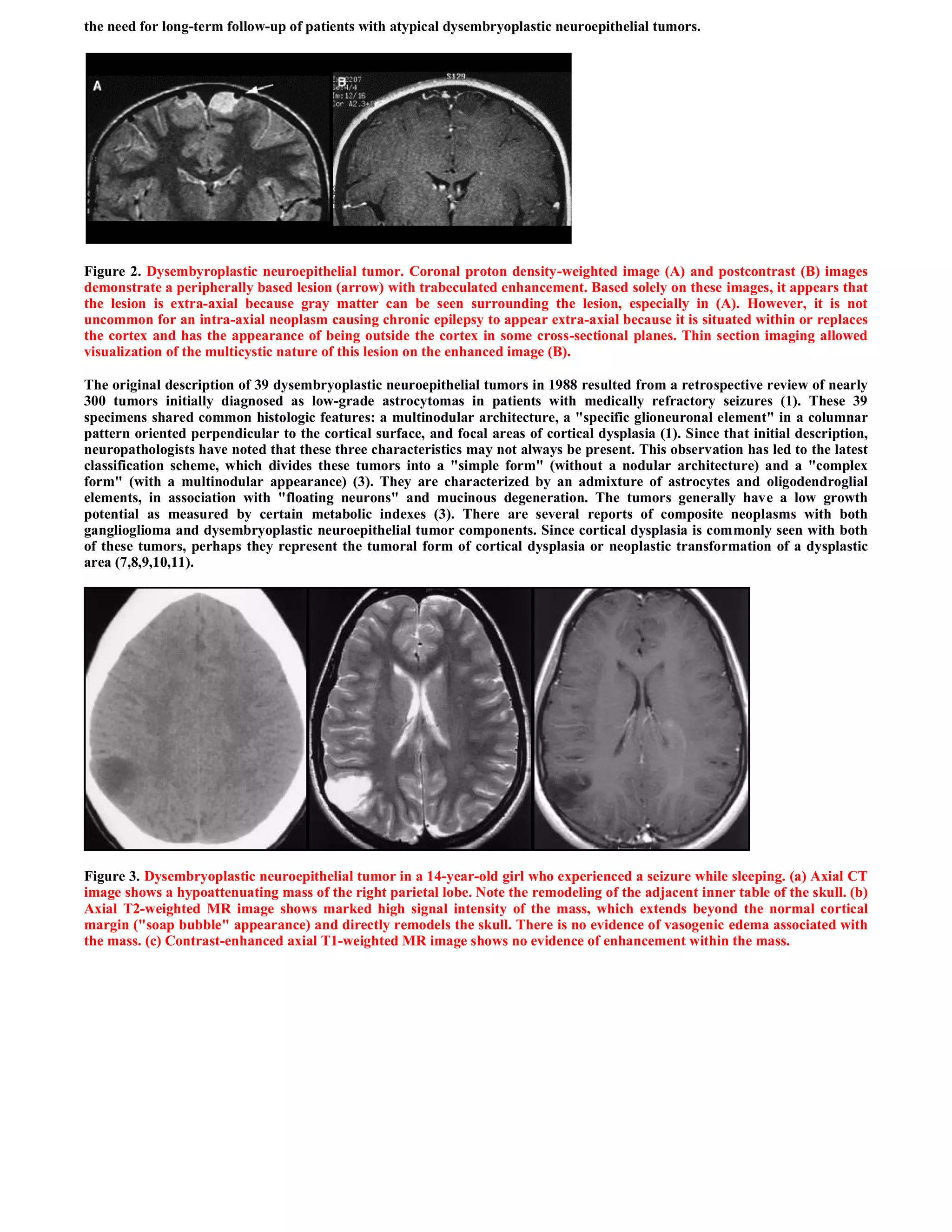 Case record...Dysembryoplastic neuroepithelial tumor | PDF