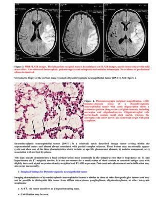 Case record...Dysembryoplastic neuroepithelial tumor | PDF