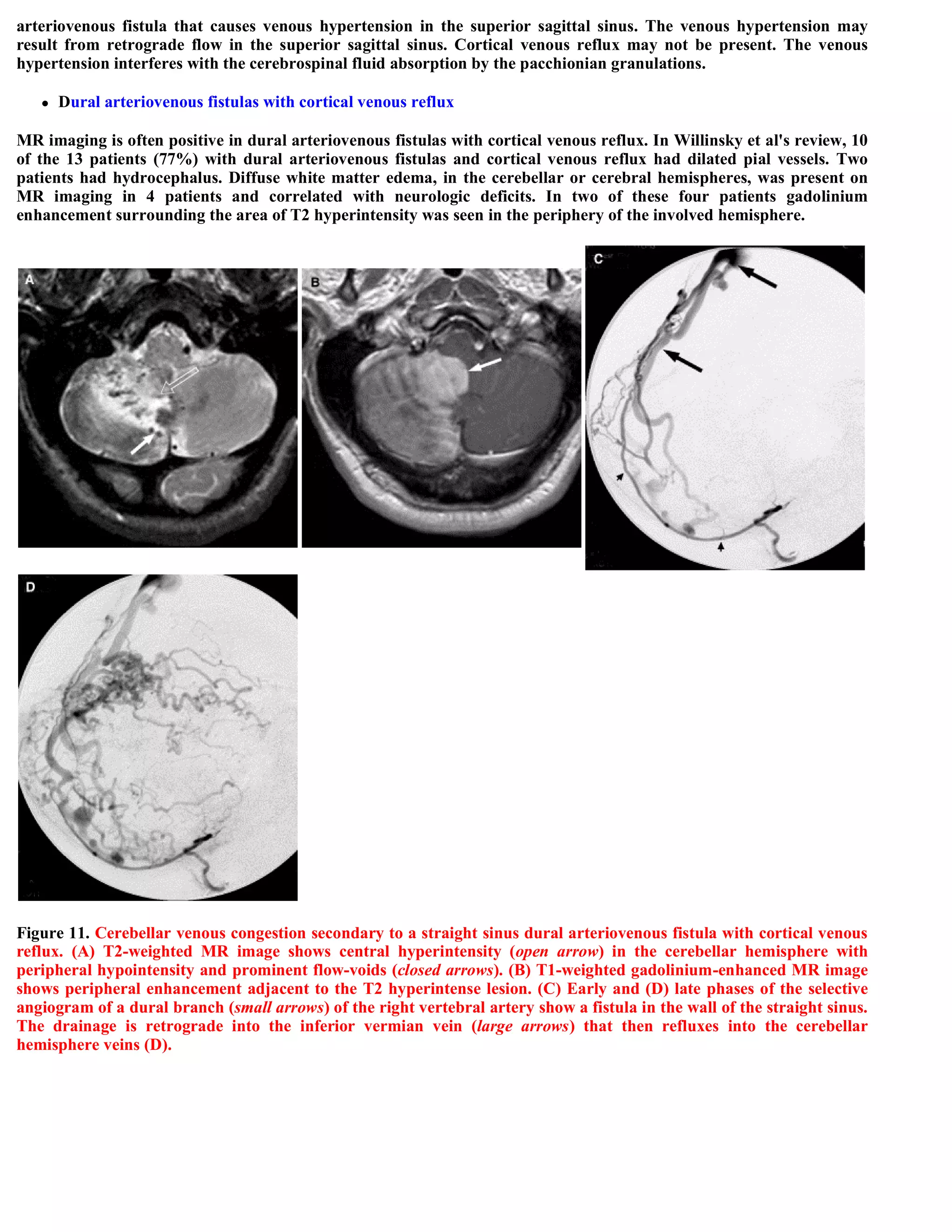 Case record...Multiple dural arteriovenous fistulas | PDF