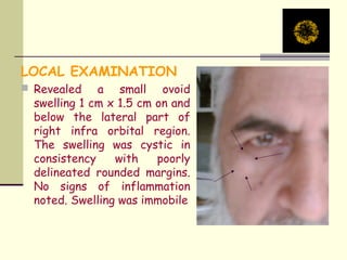Case fungal osteomyelitis. | PPT