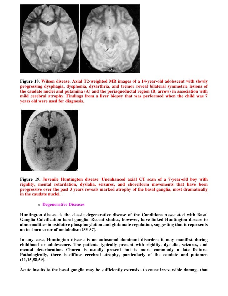 Causes Of Cerebral Atrophy In Young Adults - universitymake