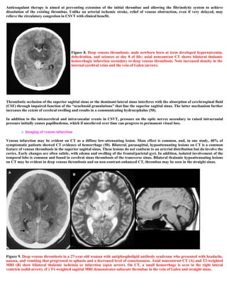 Case record...Arterial embolic hemorrhagic infarction | PDF
