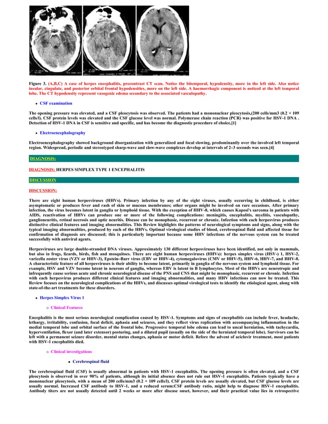 Case record...Herpes simplex type 1 encephalitis | PDF
