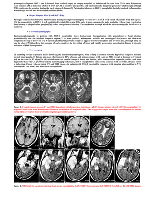 Case record...Herpes simplex type 1 encephalitis | PDF