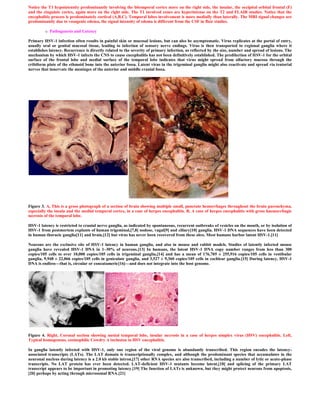 Case record...Herpes simplex type 1 encephalitis | PDF