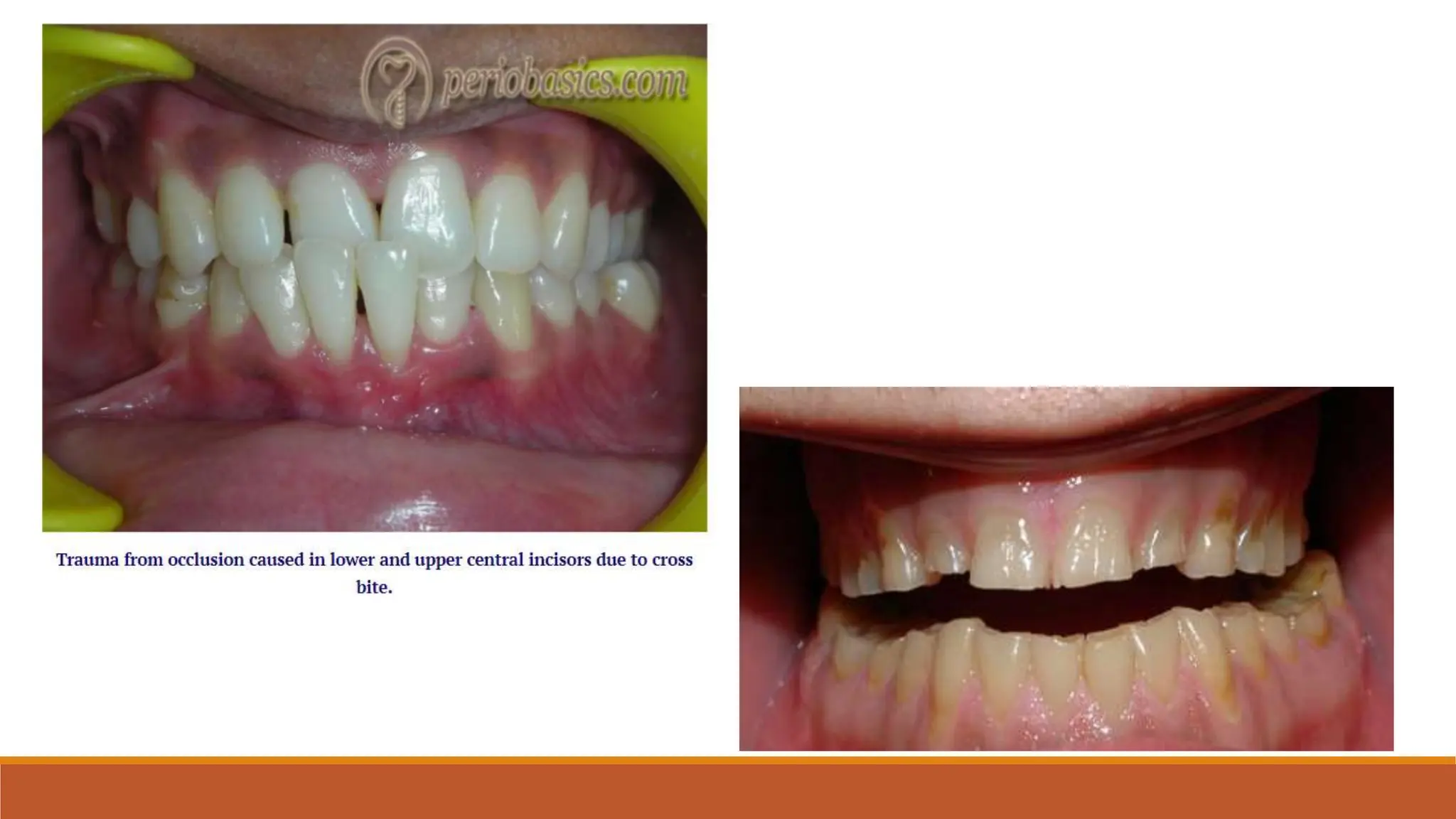 intraoral and extraoral examination.pptx