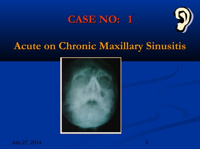 Case history sinusitis | PPT | Ear, Nose and Throat Conditions ...