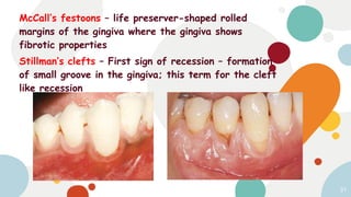 Periodontal Case History | PPT