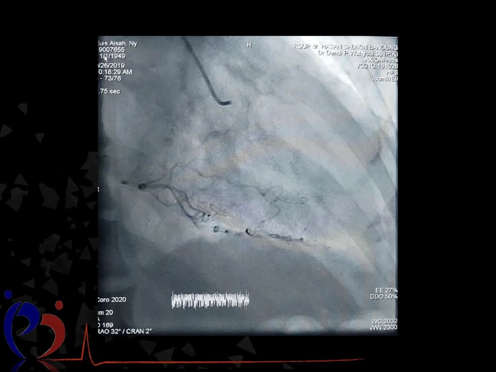 Case Myocardial Infarction Type two .pptx