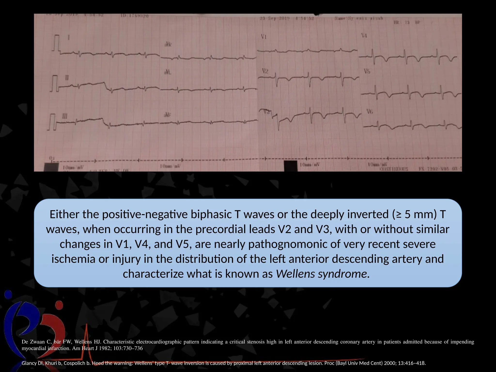 Case Myocardial Infarction Type two .pptx