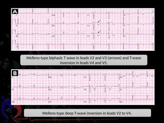 Case Myocardial Infarction Type two .pptx