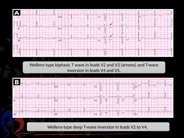 Case Myocardial Infarction Type two .pptx | Heart and Cardiovascular ...