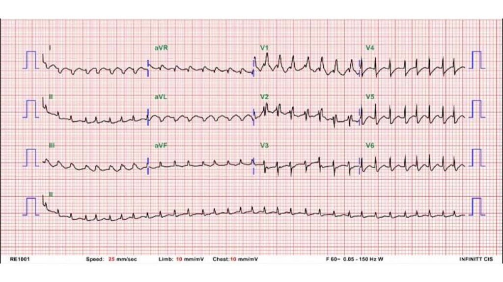 Case Infective Endocarditis