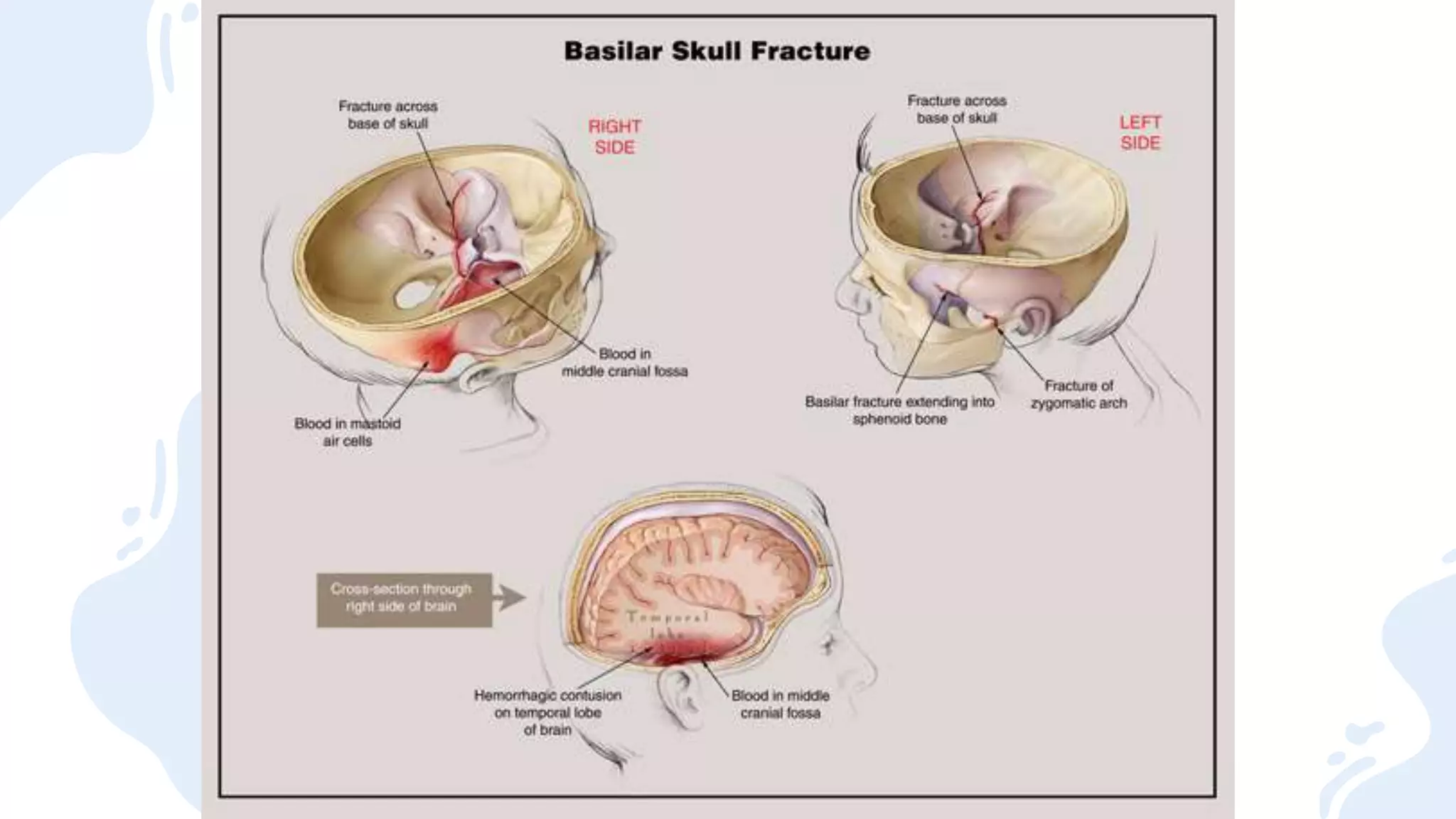 Case Iship Fraktur Basis Cranii.pptx