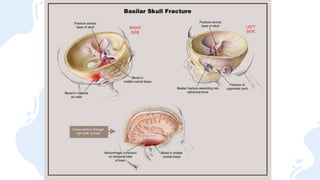 Case Iship Fraktur Basis Cranii.pptx