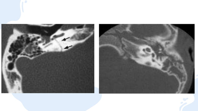 Case Iship Fraktur Basis Cranii.pptx