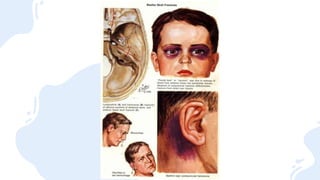 Case Iship Fraktur Basis Cranii.pptx