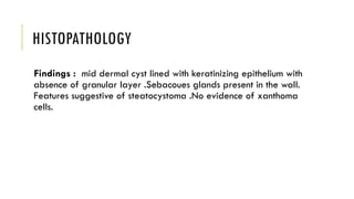 STEATOCYSTOMA MULTIPLEX - A Case study | PPTX