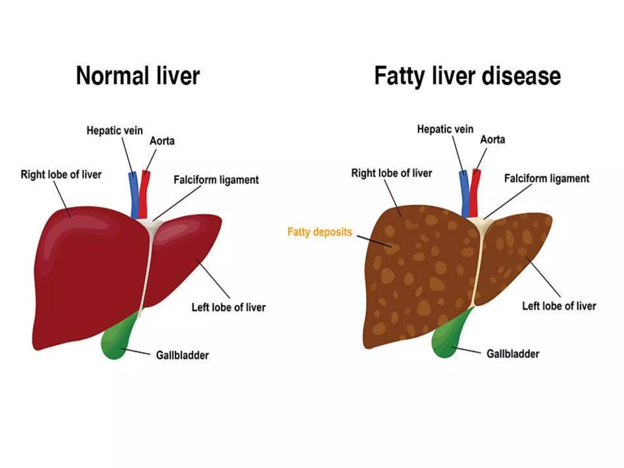CASE PRESENTATION OF LIVER CIRRHOSIS PPT by MADHUKAR THAGNAR | PPTX