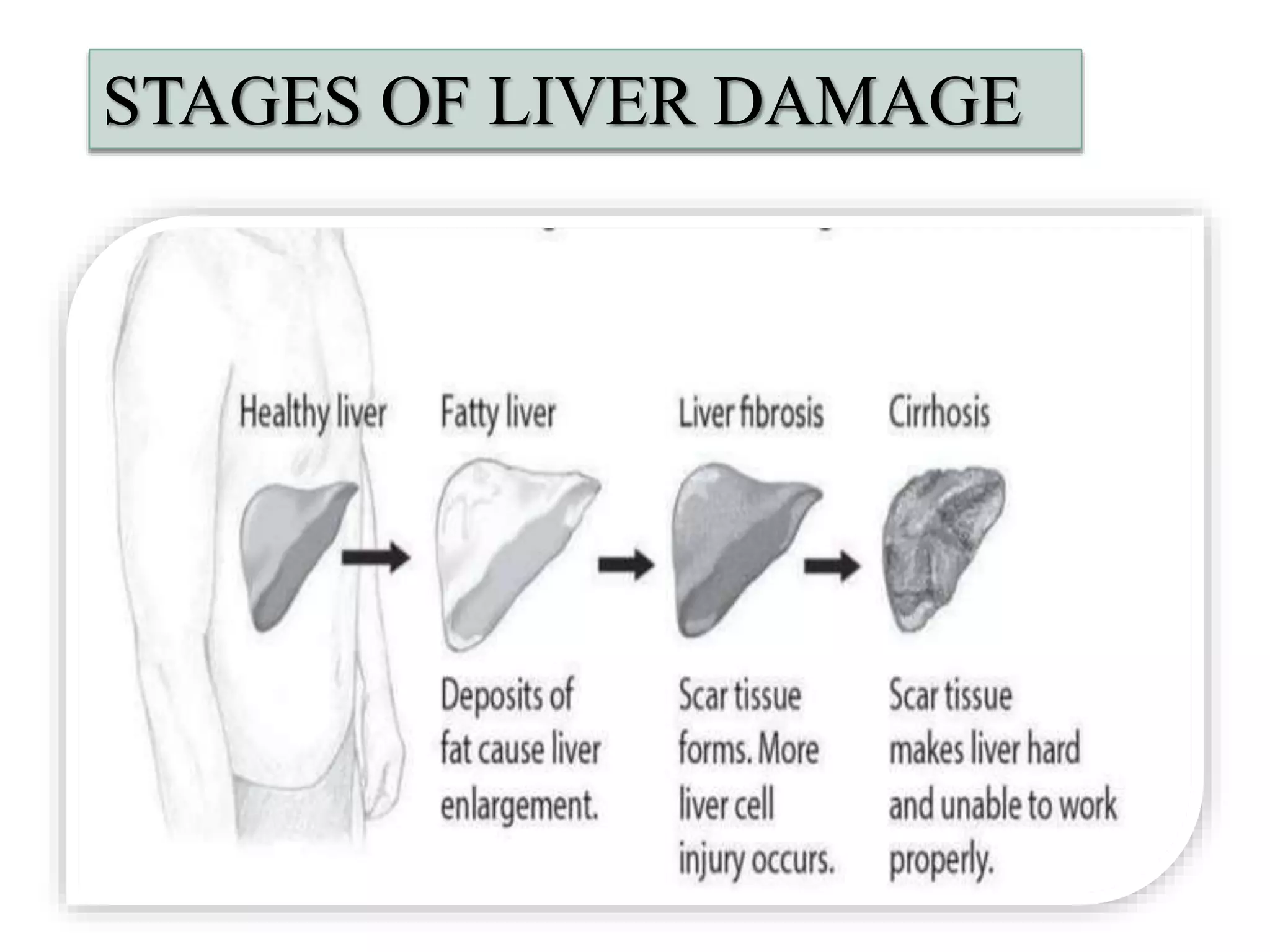 CASE PRESENTATION OF LIVER CIRRHOSIS PPT by MADHUKAR THAGNAR | PPTX