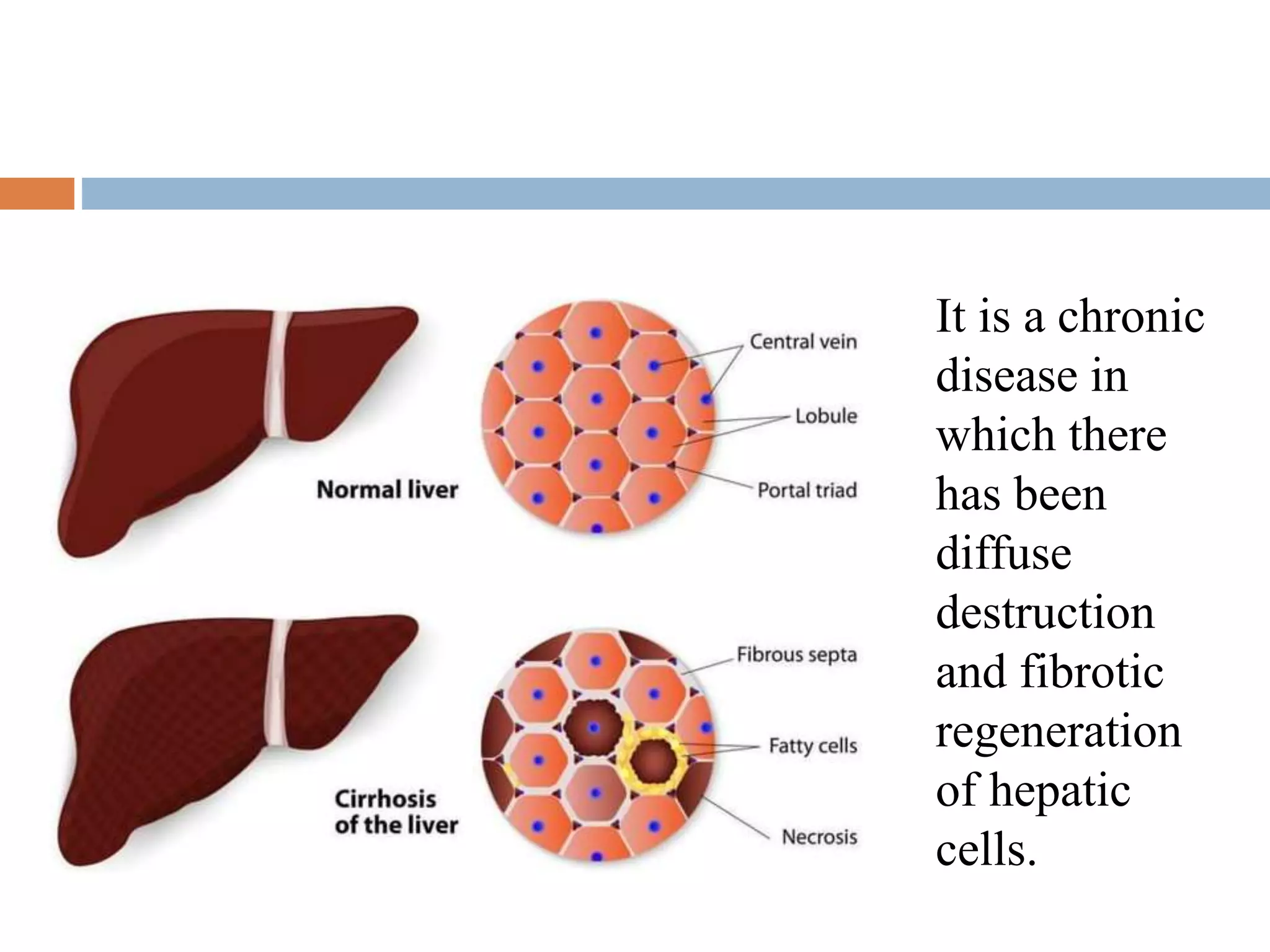 CASE PRESENTATION OF LIVER CIRRHOSIS PPT by MADHUKAR THAGNAR | PPTX