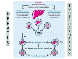 CASE PRESENTATION OF LIVER CIRRHOSIS PPT by MADHUKAR THAGNAR | PPTX