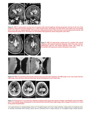 Case Record Subependymal Cns Lymphoma Pdf